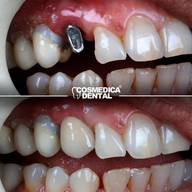 Turkey teeth before and after - Cosmedica Dental Clinic