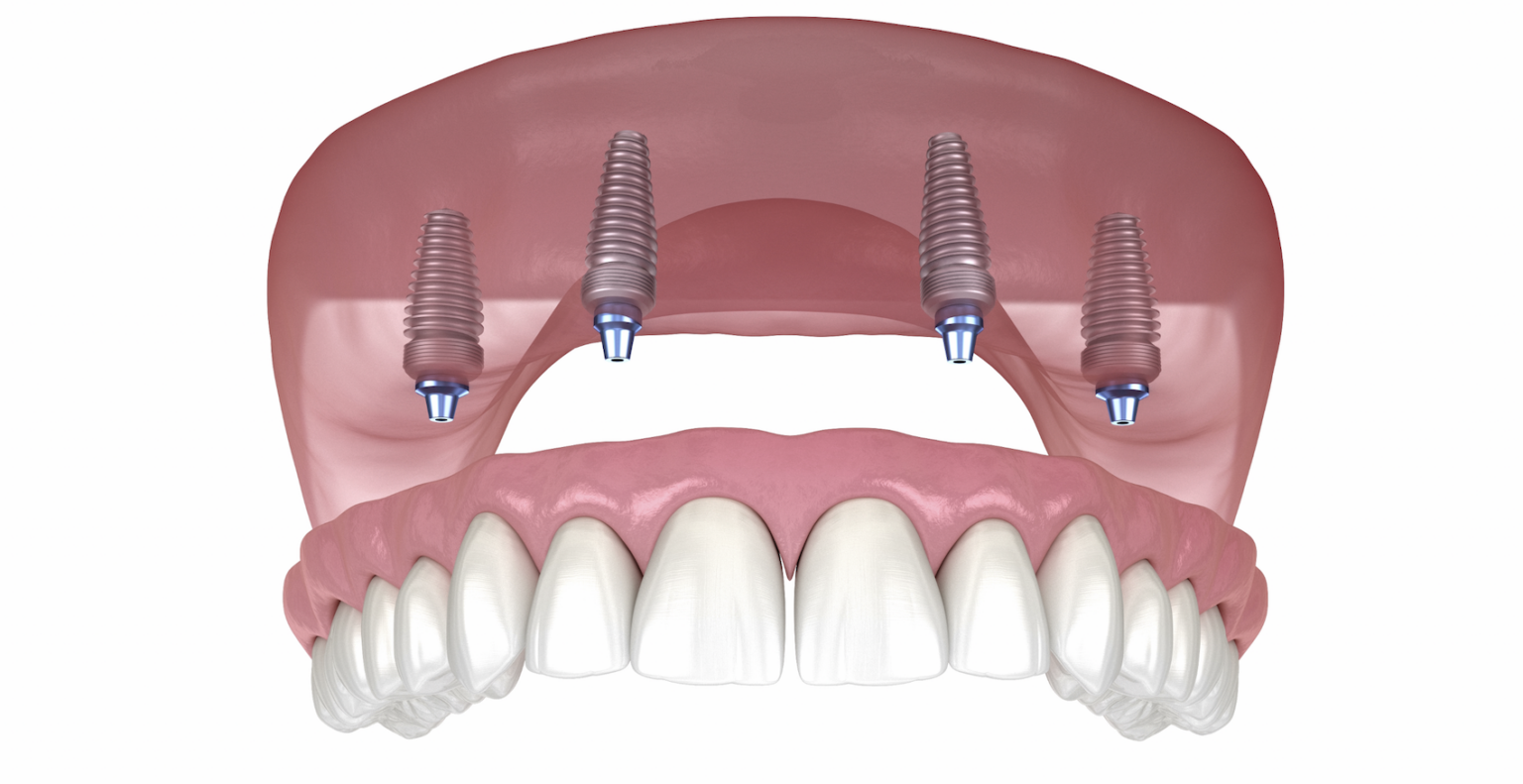 All on 4 Dental Implants in Turkey - cosmedicadental.com